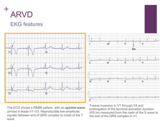 arrhythmogenic right ventricular dysplasia/Cardiomyopathy | PPTX