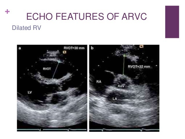 arrhythmogenic right ventricular dysplasia/Cardiomyopathy