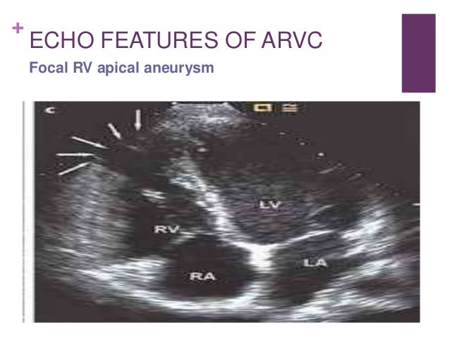 arrhythmogenic right ventricular dysplasia/Cardiomyopathy