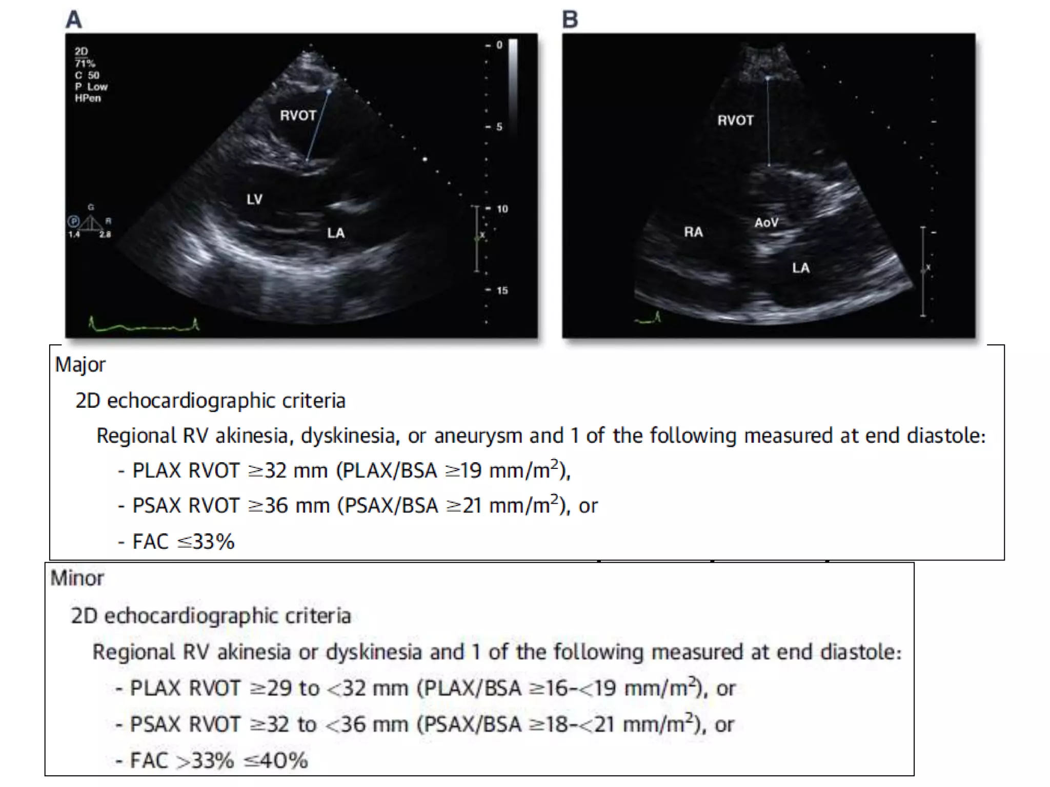 ARRHYTHMOGENIC RIGHT VENTRICULAR DYSPLASIA/CARDIOMYOPATHY | PPTX
