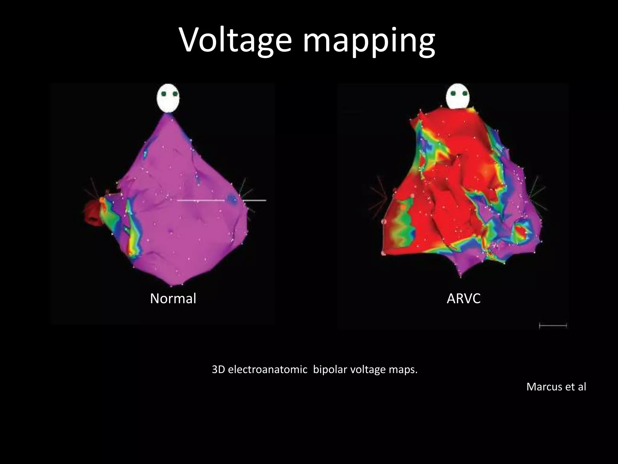 ARRHYTHMOGENIC RIGHT VENTRICULAR DYSPLASIA/CARDIOMYOPATHY | PPTX