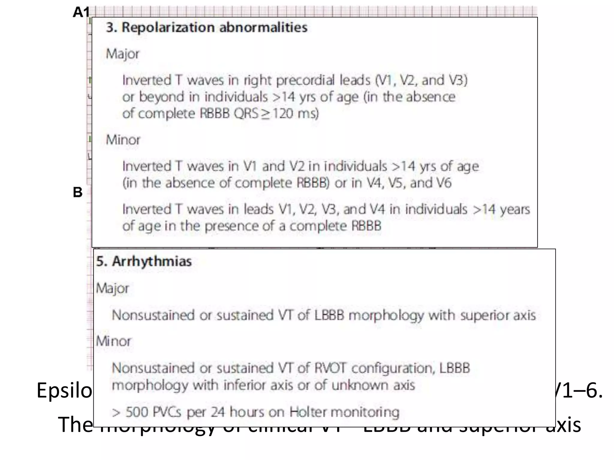 ARRHYTHMOGENIC RIGHT VENTRICULAR DYSPLASIA/CARDIOMYOPATHY | PPTX