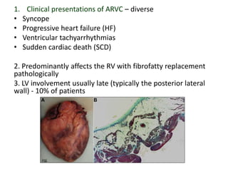 ARRHYTHMOGENIC RIGHT VENTRICULAR DYSPLASIA/CARDIOMYOPATHY | PPTX