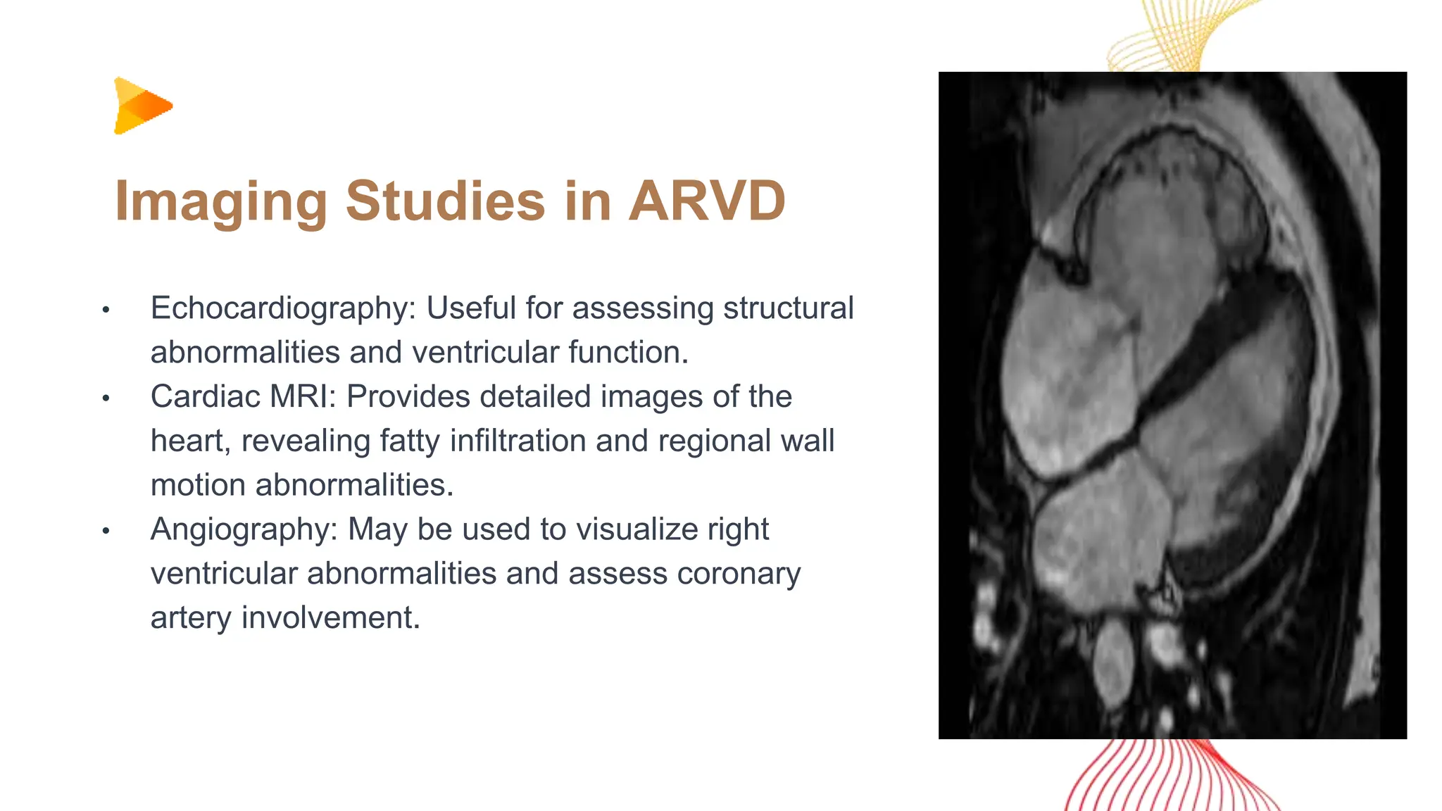 Arrhythmogenic Right Ventricular Dysrhythmias.pptx