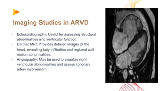 Arrhythmogenic Right Ventricular Dysrhythmias.pptx
