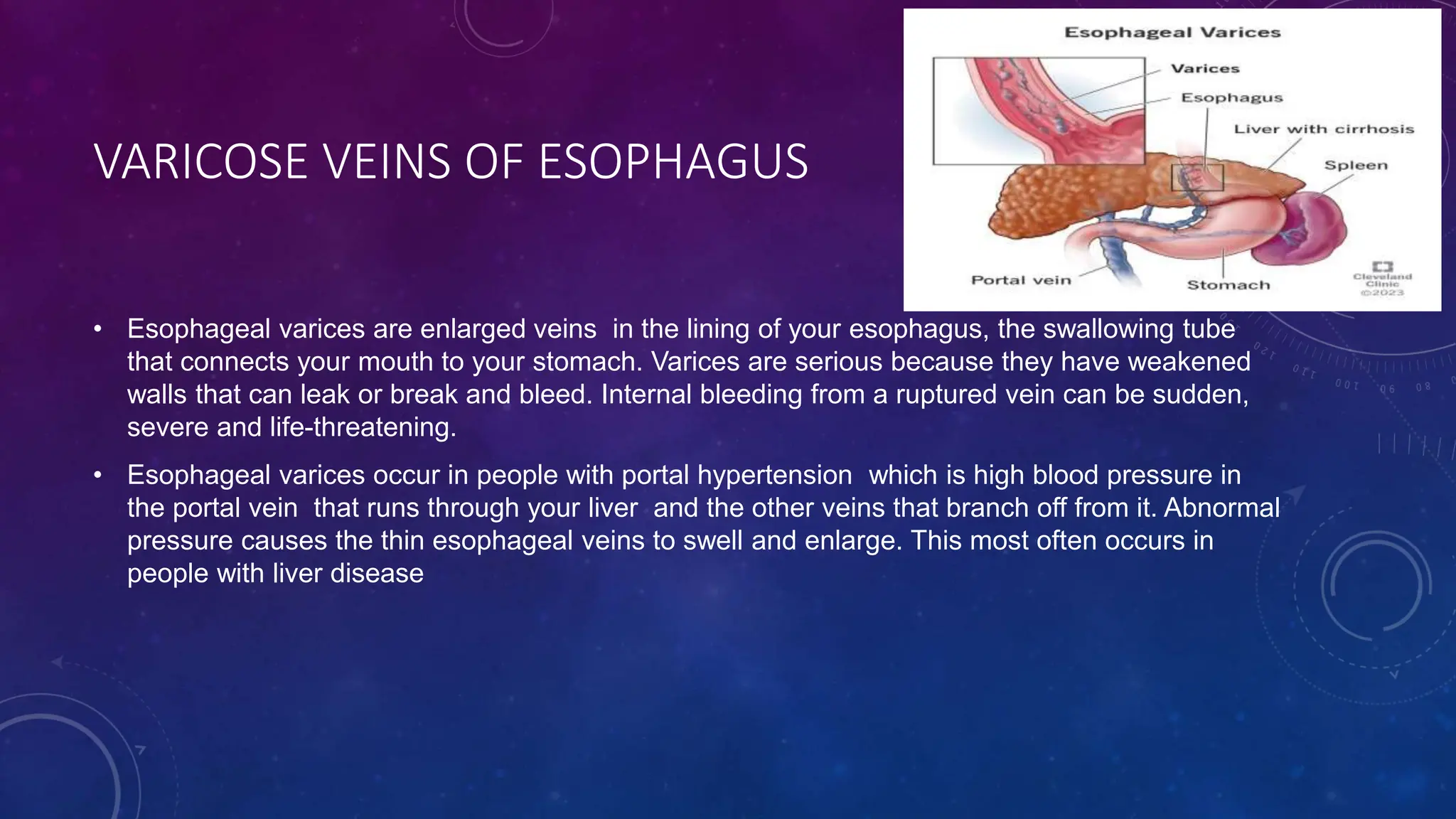 Complications of gastric ulcer and duodenal ulcer (bleeding ...