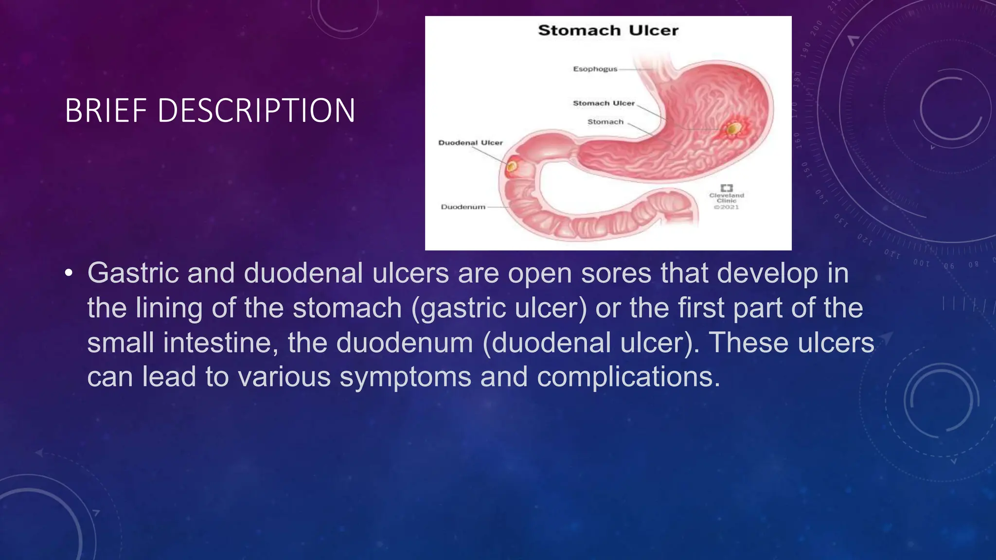 Complications of gastric ulcer and duodenal ulcer (bleeding ...