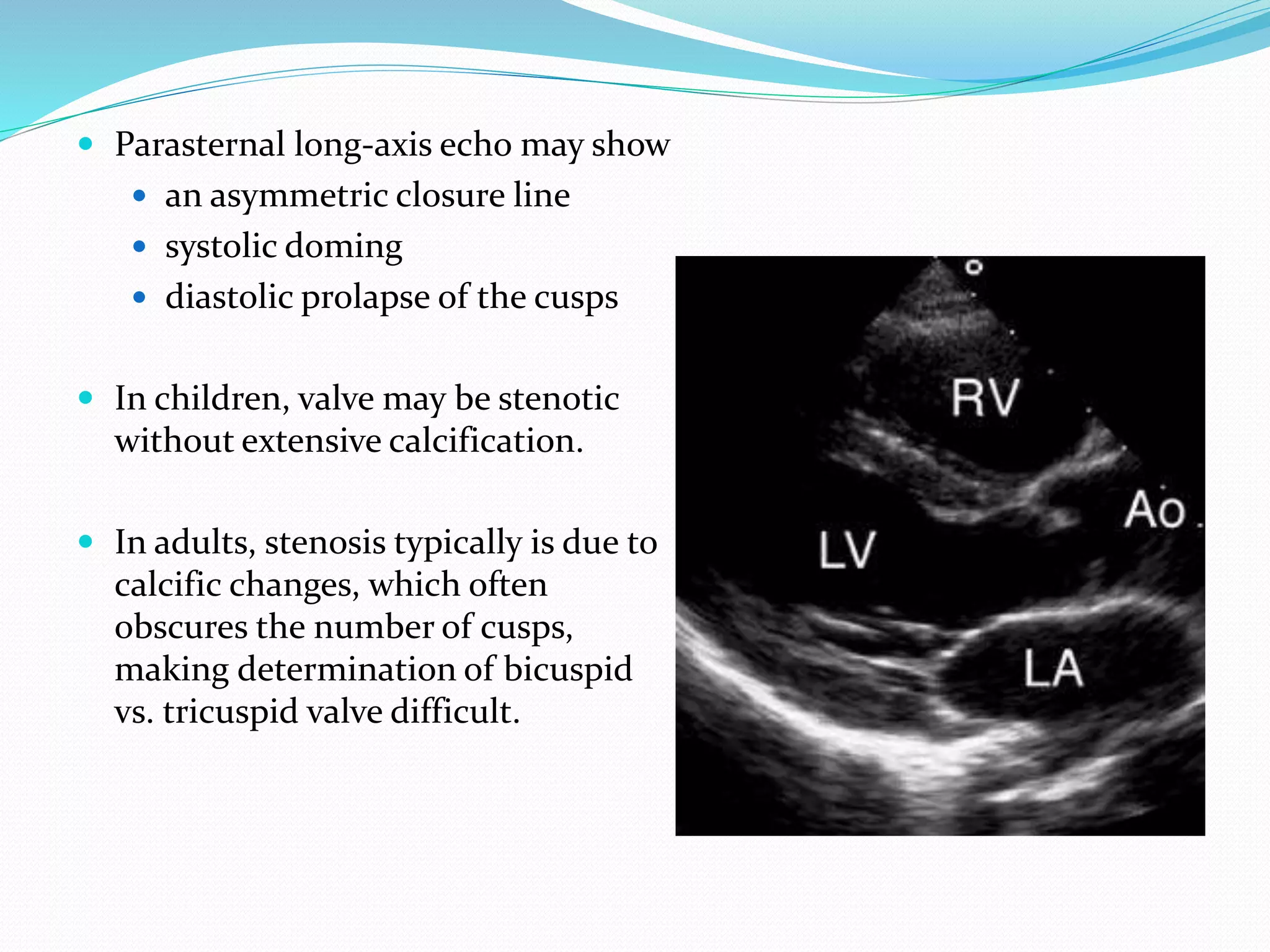 Aortic stenosis - Echocardiography | PPTX