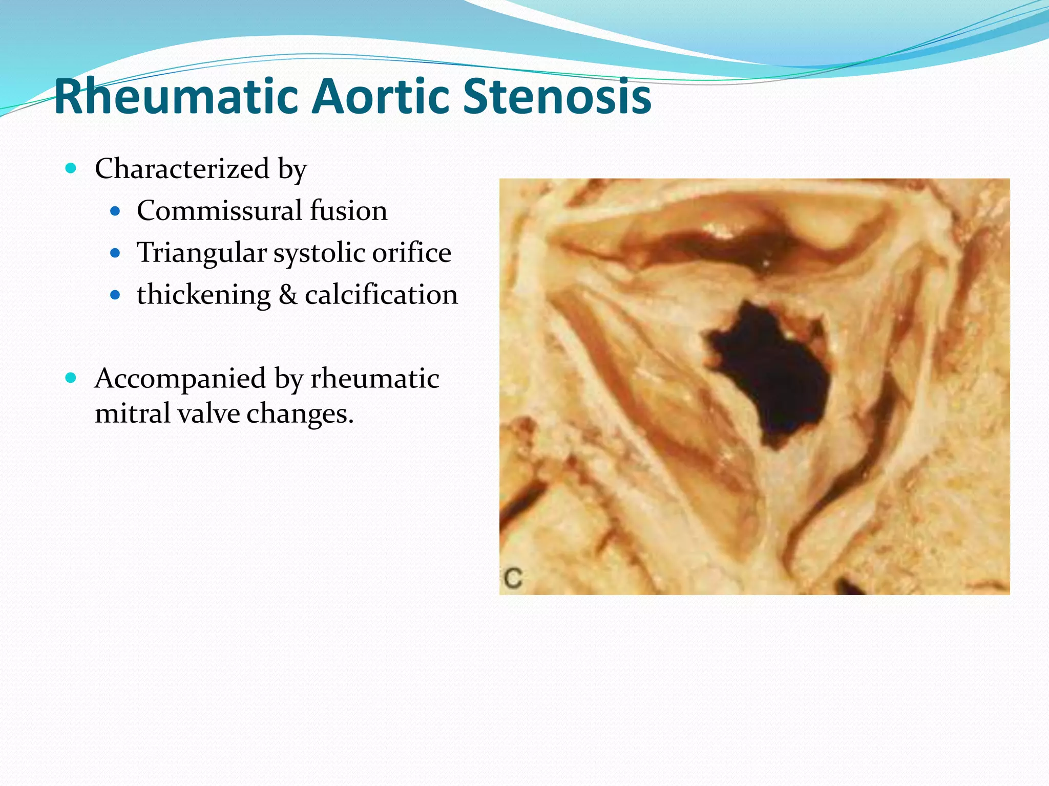 Aortic stenosis - Echocardiography | PPTX