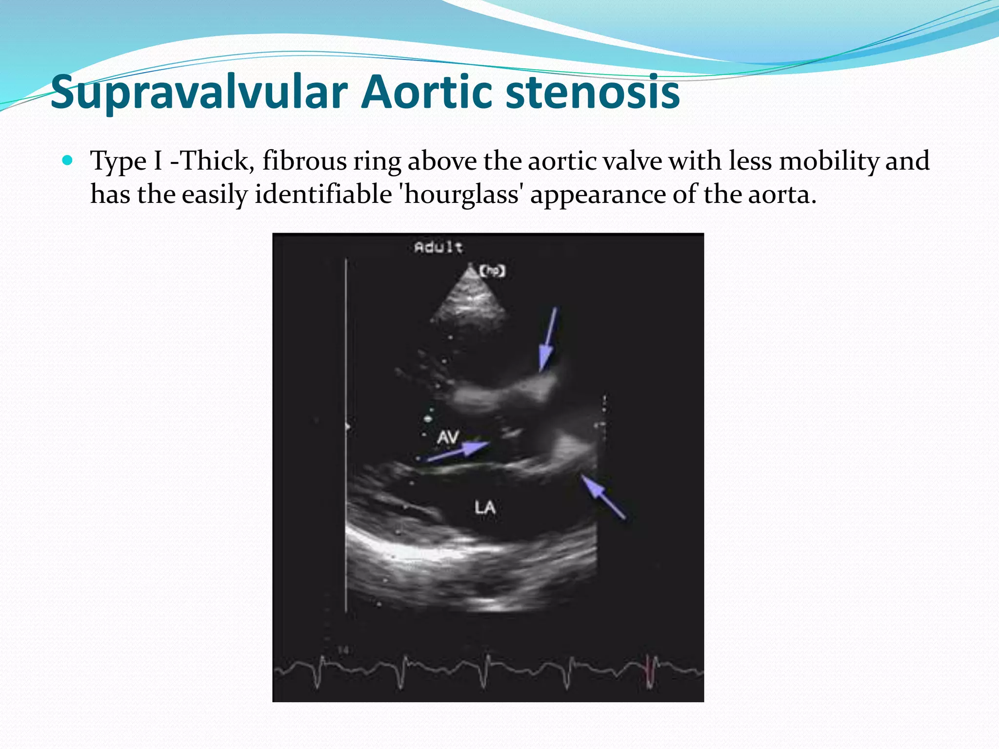 Aortic stenosis - Echocardiography | PPTX
