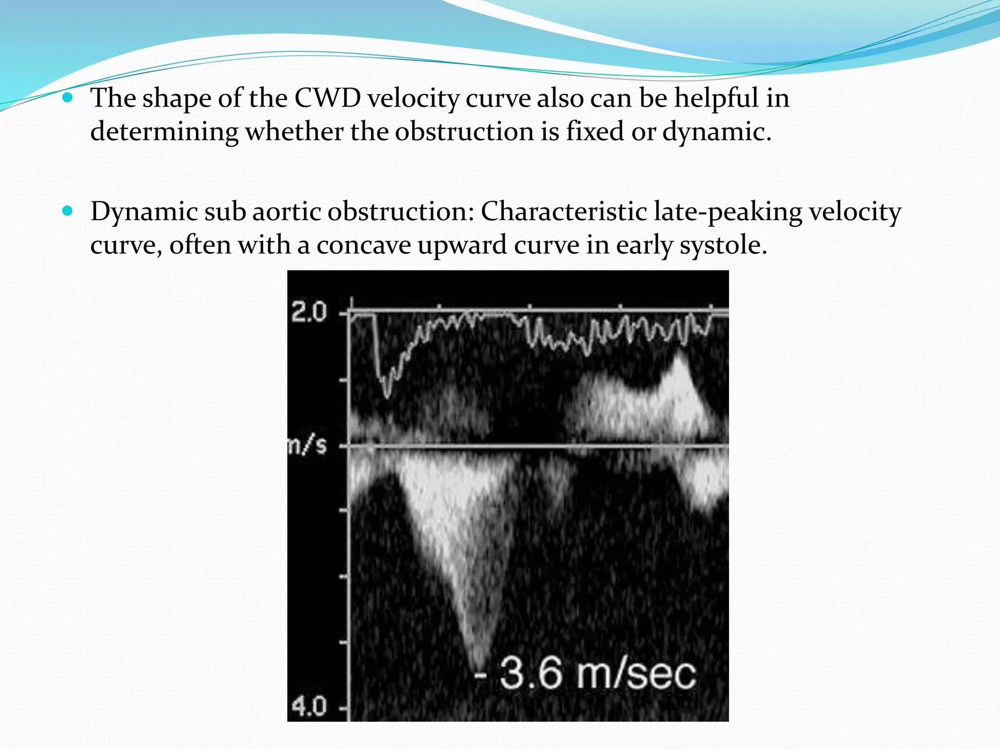 Aortic stenosis - Echocardiography | PPTX