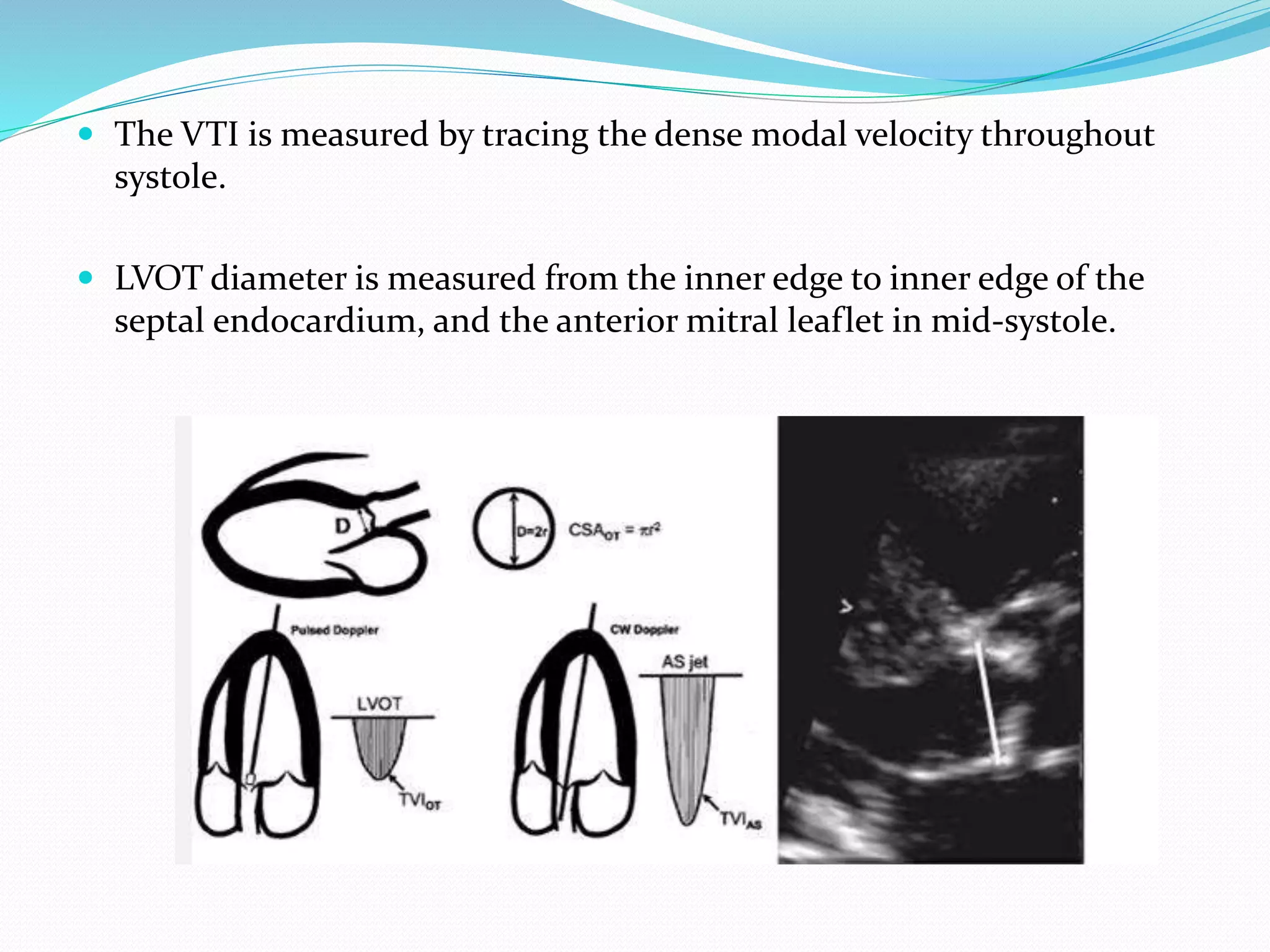 Aortic stenosis - Echocardiography | PPTX