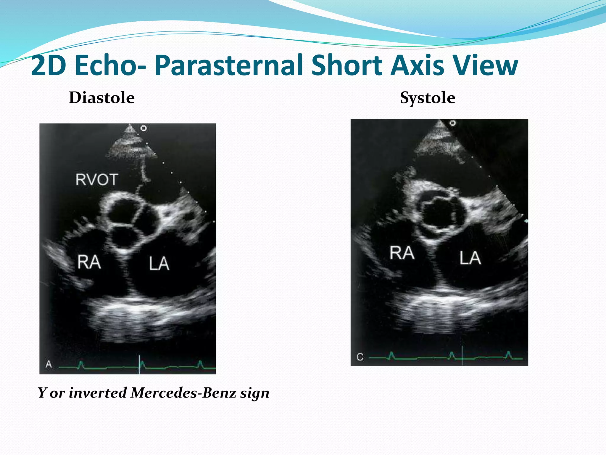 Aortic stenosis - Echocardiography | PPTX