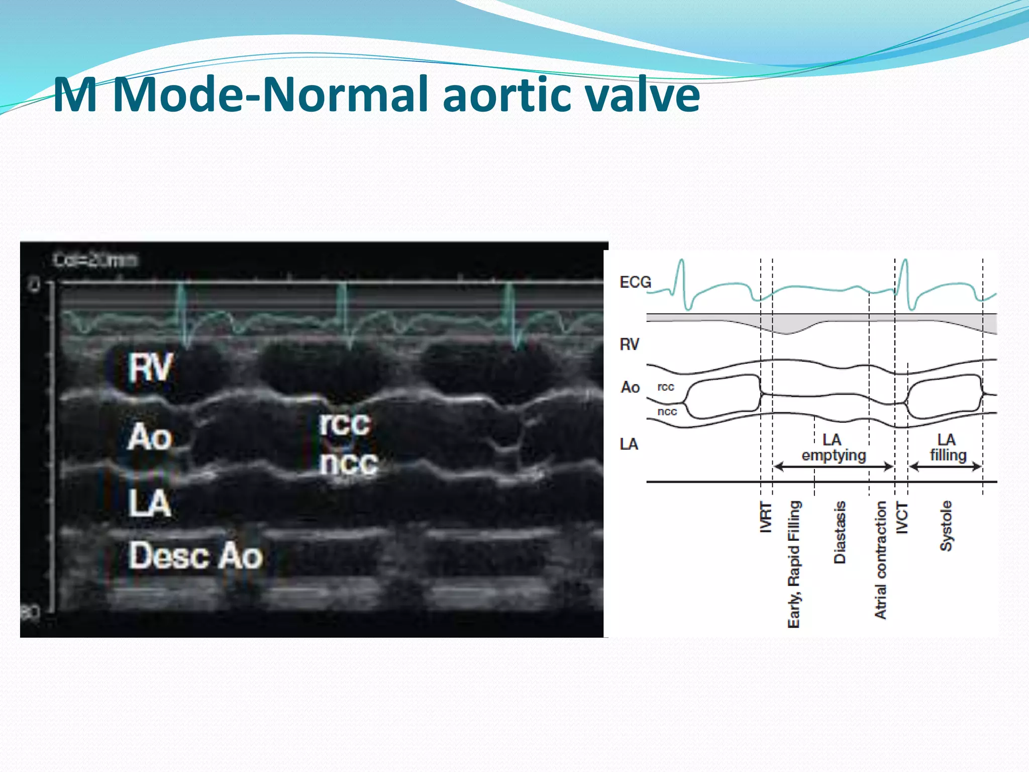 Aortic stenosis - Echocardiography | PPTX