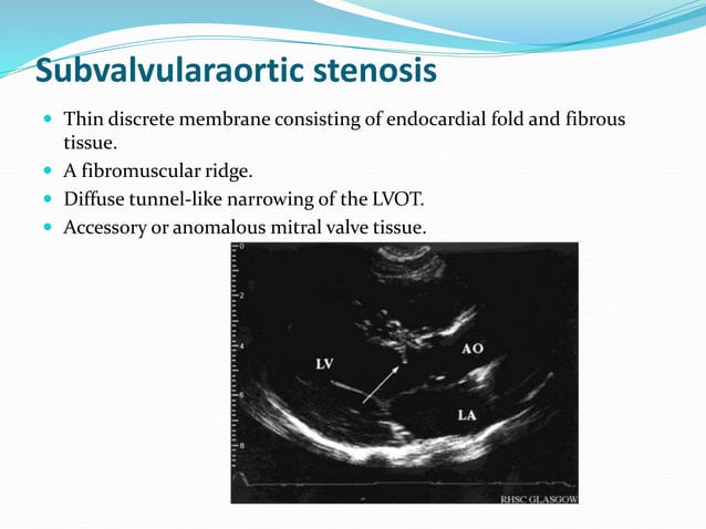 Aortic stenosis - Echocardiography | PPTX
