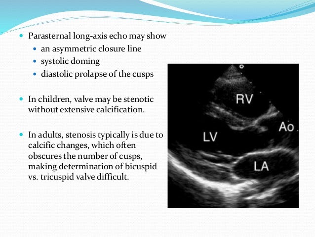 Aortic stenosis - Echocardiography
