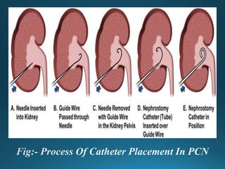 PERCITANEOUS NEPHROSTOMY and HYSTEROSALPIONGOGRAPHY | PPTX