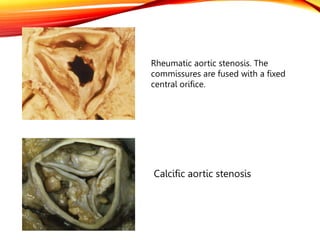 Aortic stenosis, cardiology, medicine.pptx