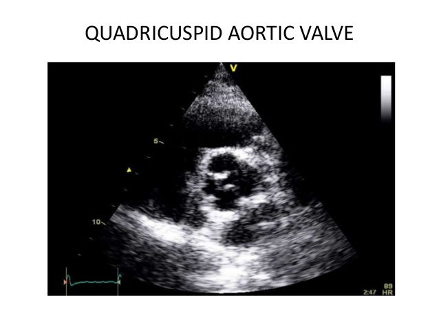 Aortic stenosis Echo