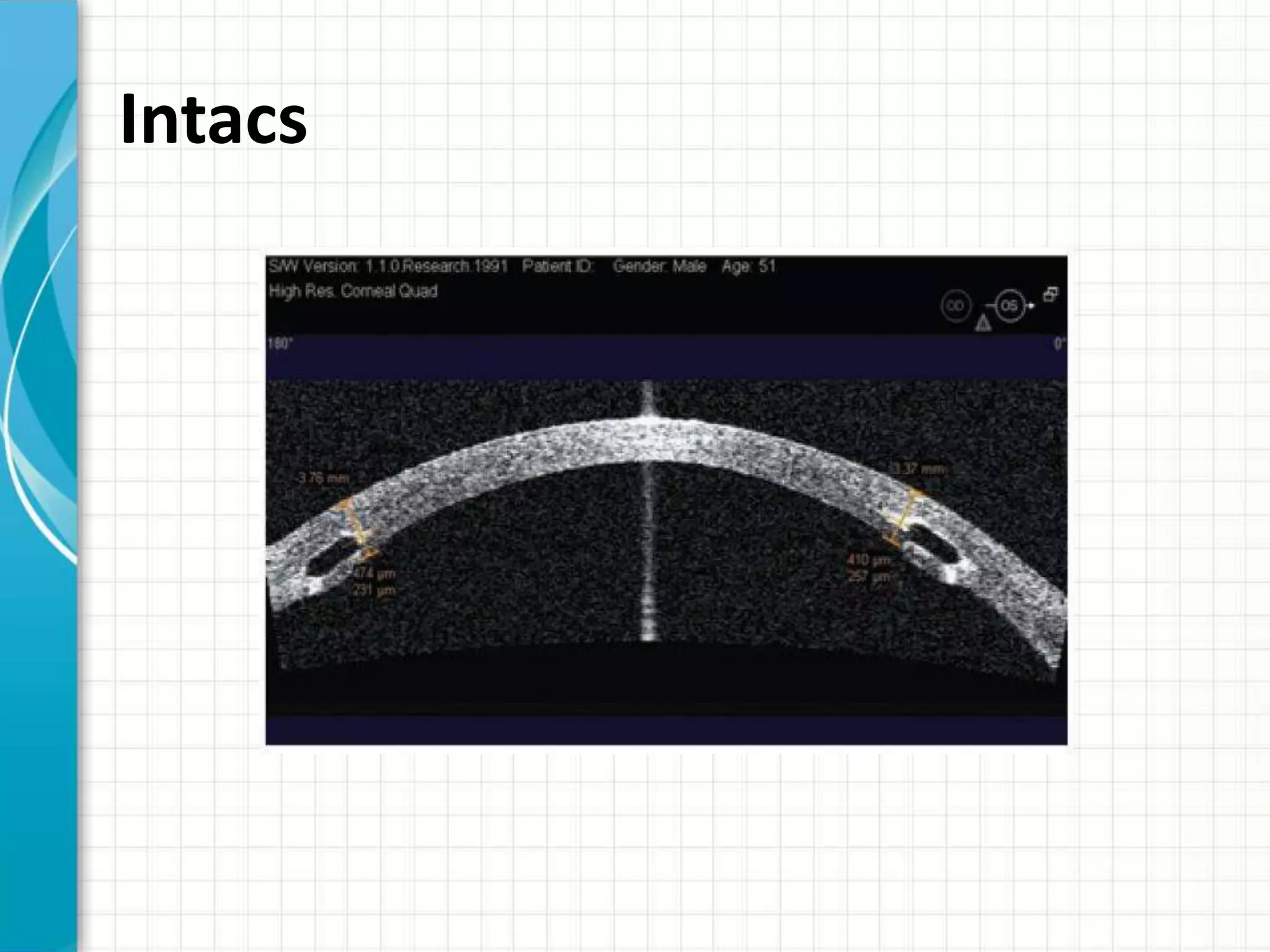 AS OCT & UBM - Dr Shylesh B Dabke | PPTX