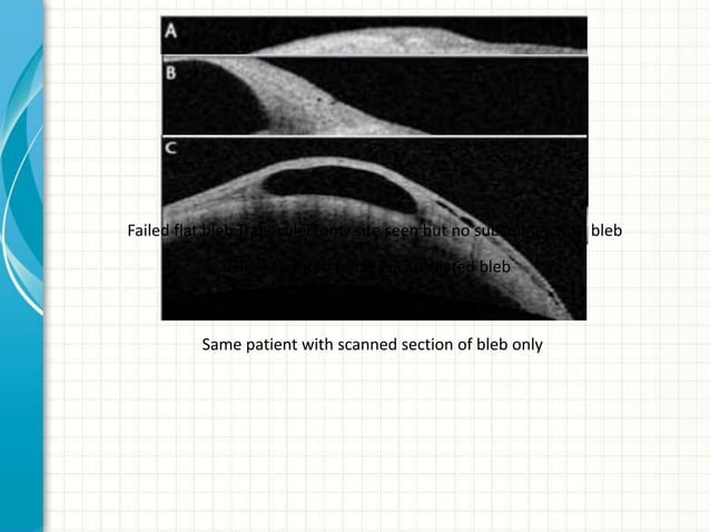 AS OCT & UBM - Dr Shylesh B Dabke | PPTX | Eye and Vision Conditions ...