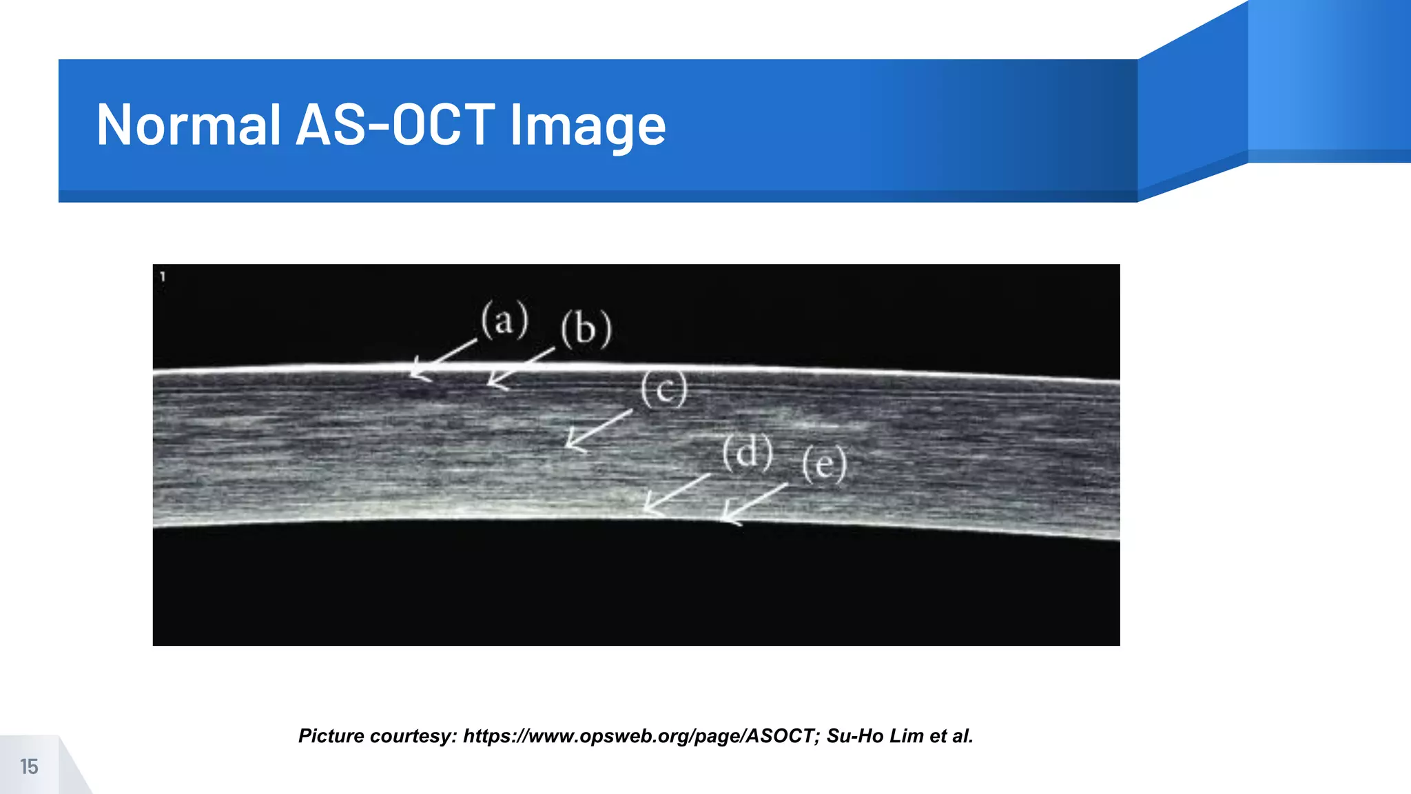 AS-OCT | PDF