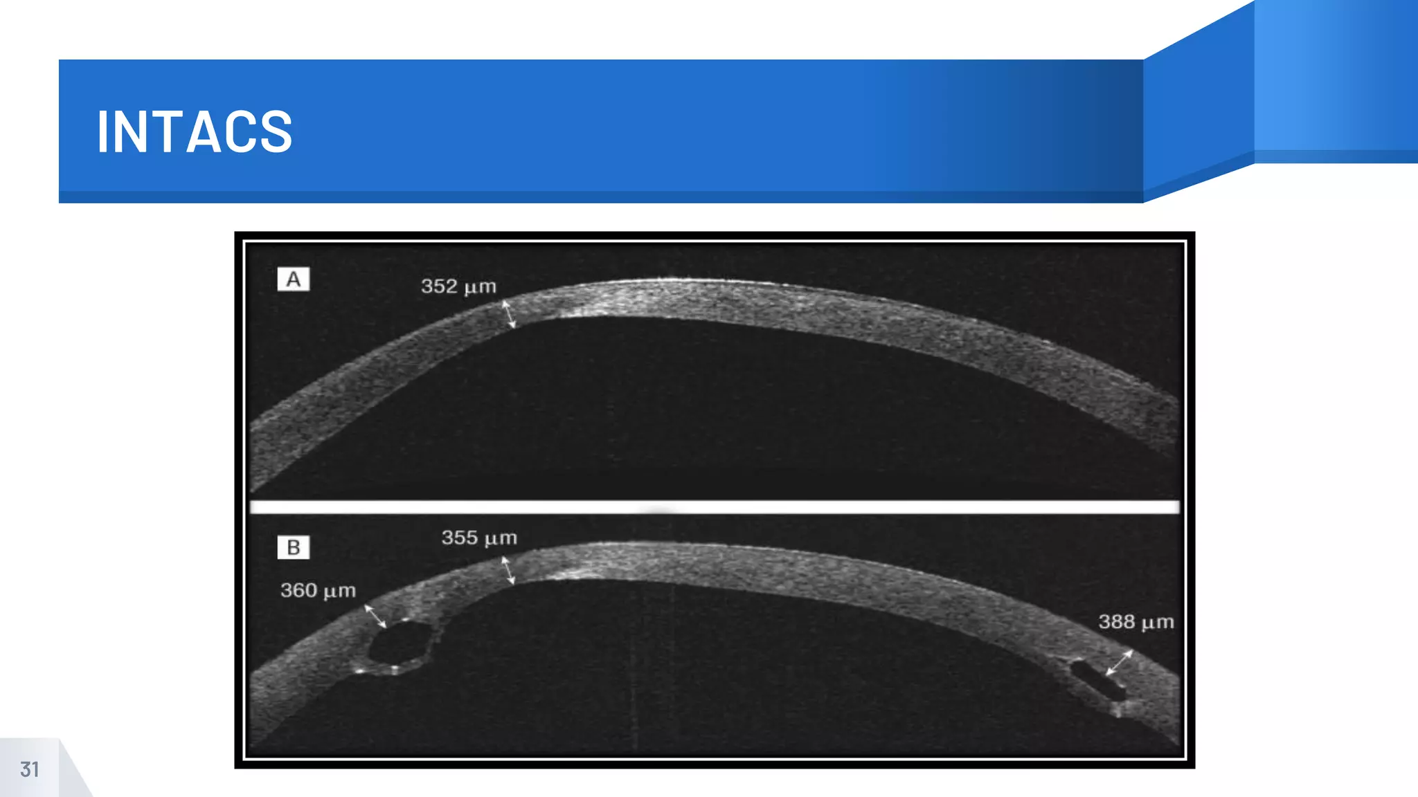 AS-OCT | PDF | Eye and Vision Conditions | Diseases and Conditions