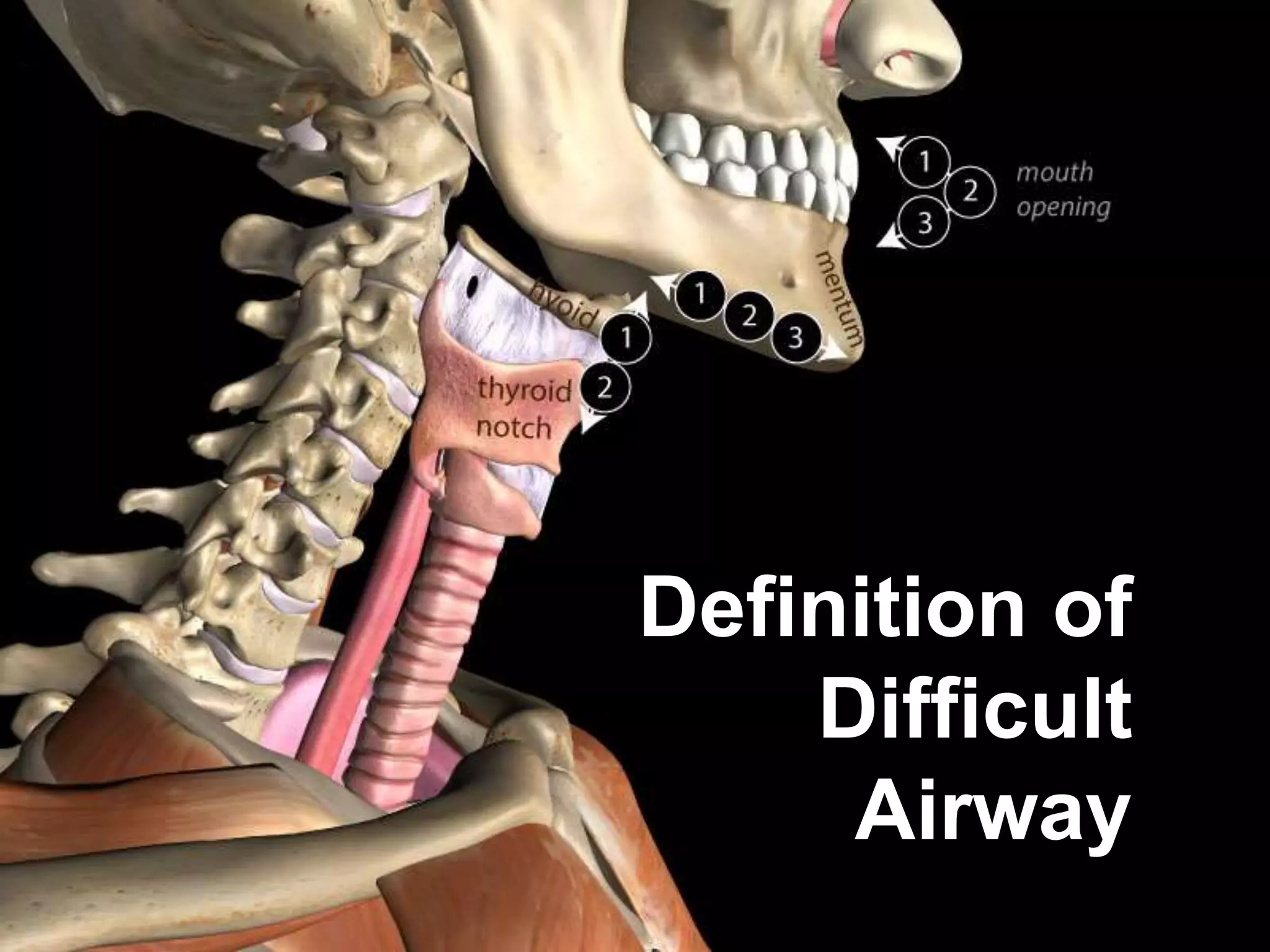 ASA Guidelines for Management of the Difficult Airway | PPTX