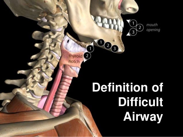 ASA Guidelines for Management of the Difficult Airway