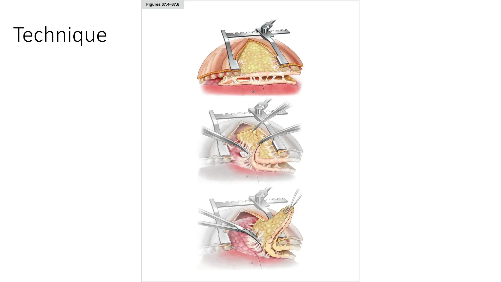 decortication of lung empyema education material | PPTX