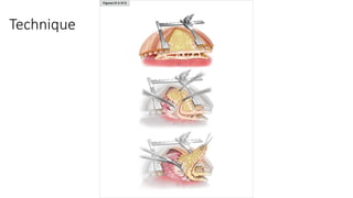 decortication of lung empyema education material | PPTX