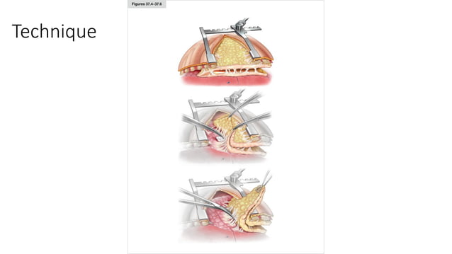 decortication of lung empyema education material | PPTX | Lung and ...