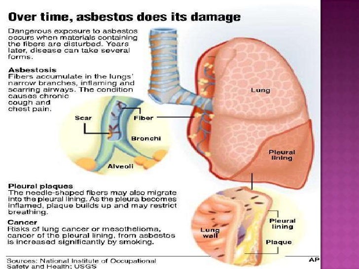 Asbestosis