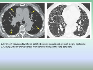 IMAGING FEATURES IN ASBESTOSIS | PPTX