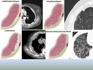 IMAGING FEATURES IN ASBESTOSIS | PPTX