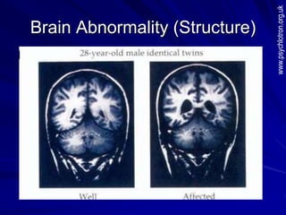 AS The biological model of abnormality | PPTX