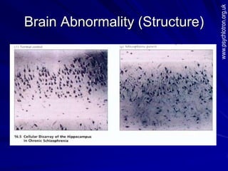 AS The biological model of abnormality | PPTX