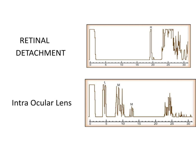 A scan ultrasonography | PPTX | Eye and Vision Conditions | Diseases ...