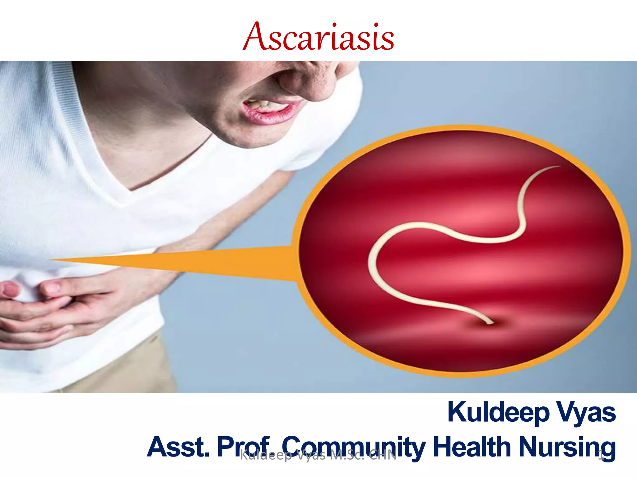Ascariasis | PPTX