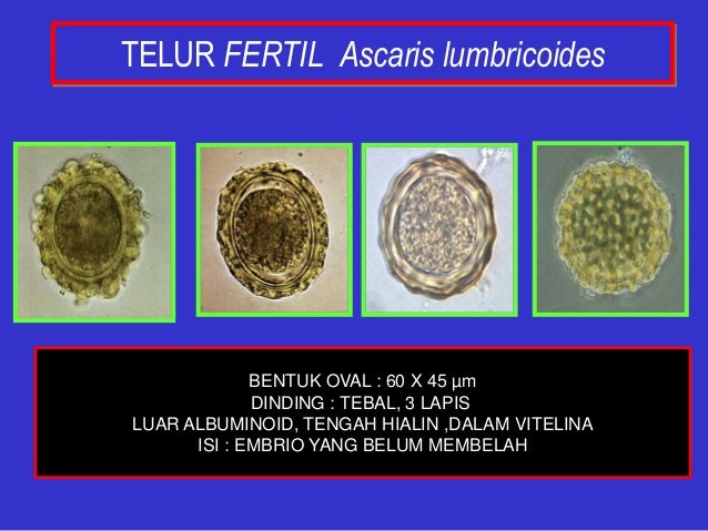 Ascariasis