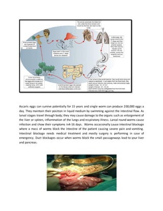 Ascariasis | DOCX