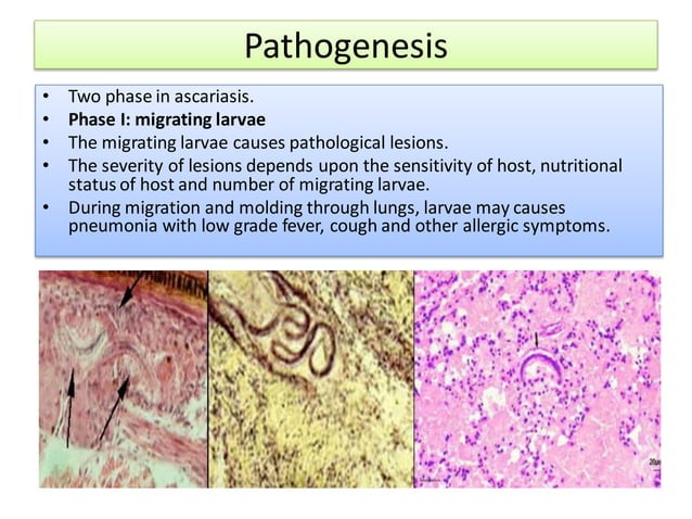Ascariasis- Roundworm Infection | PDF | Infectious Diseases | Diseases ...