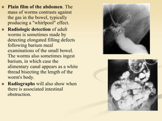 ASCARIASIS.............................................. | PPT