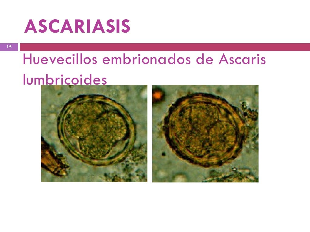 Ascariasis