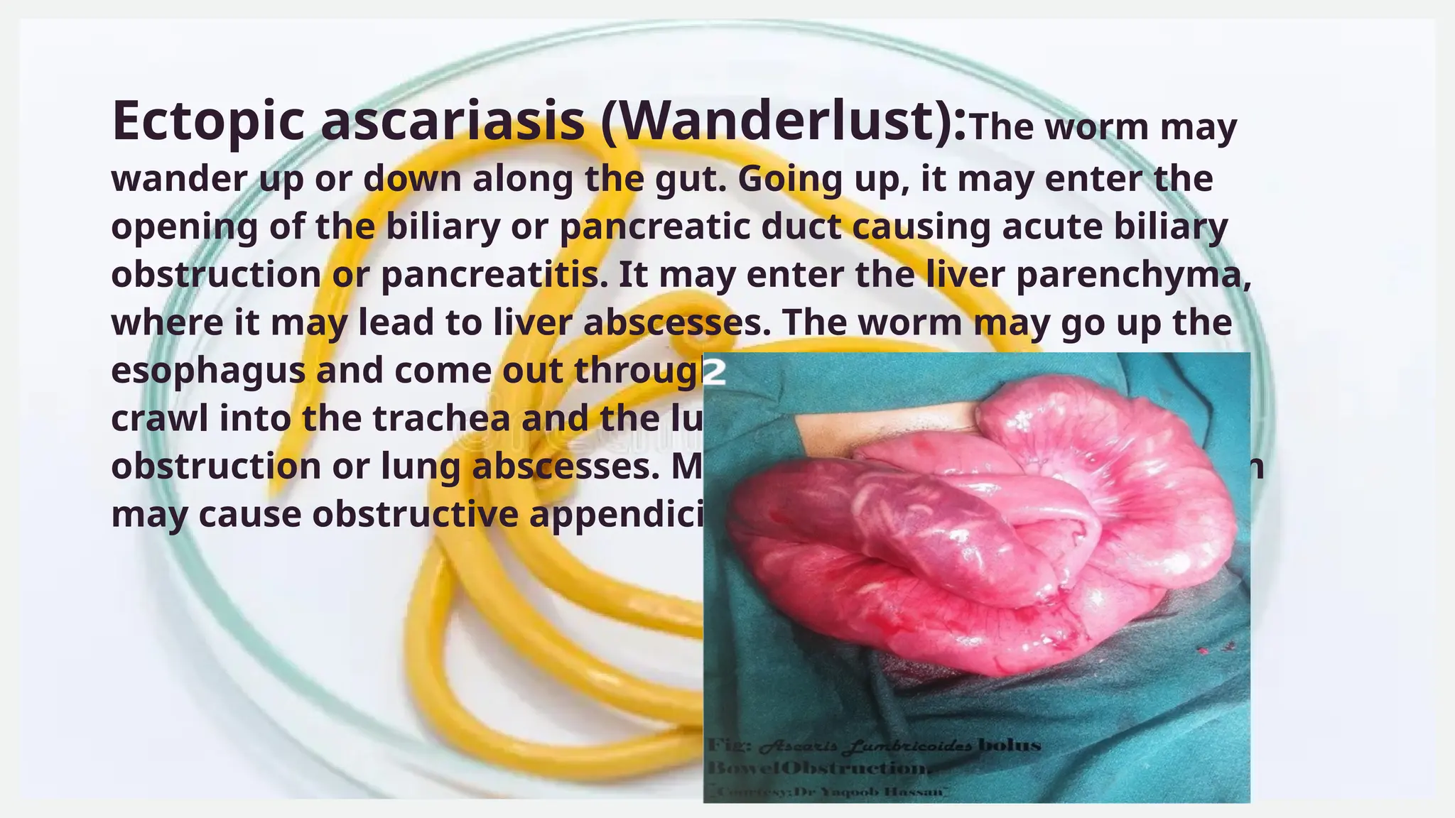 ASCARIS-PATHOGENESIS AND CLINICAL FEATURE.pptx