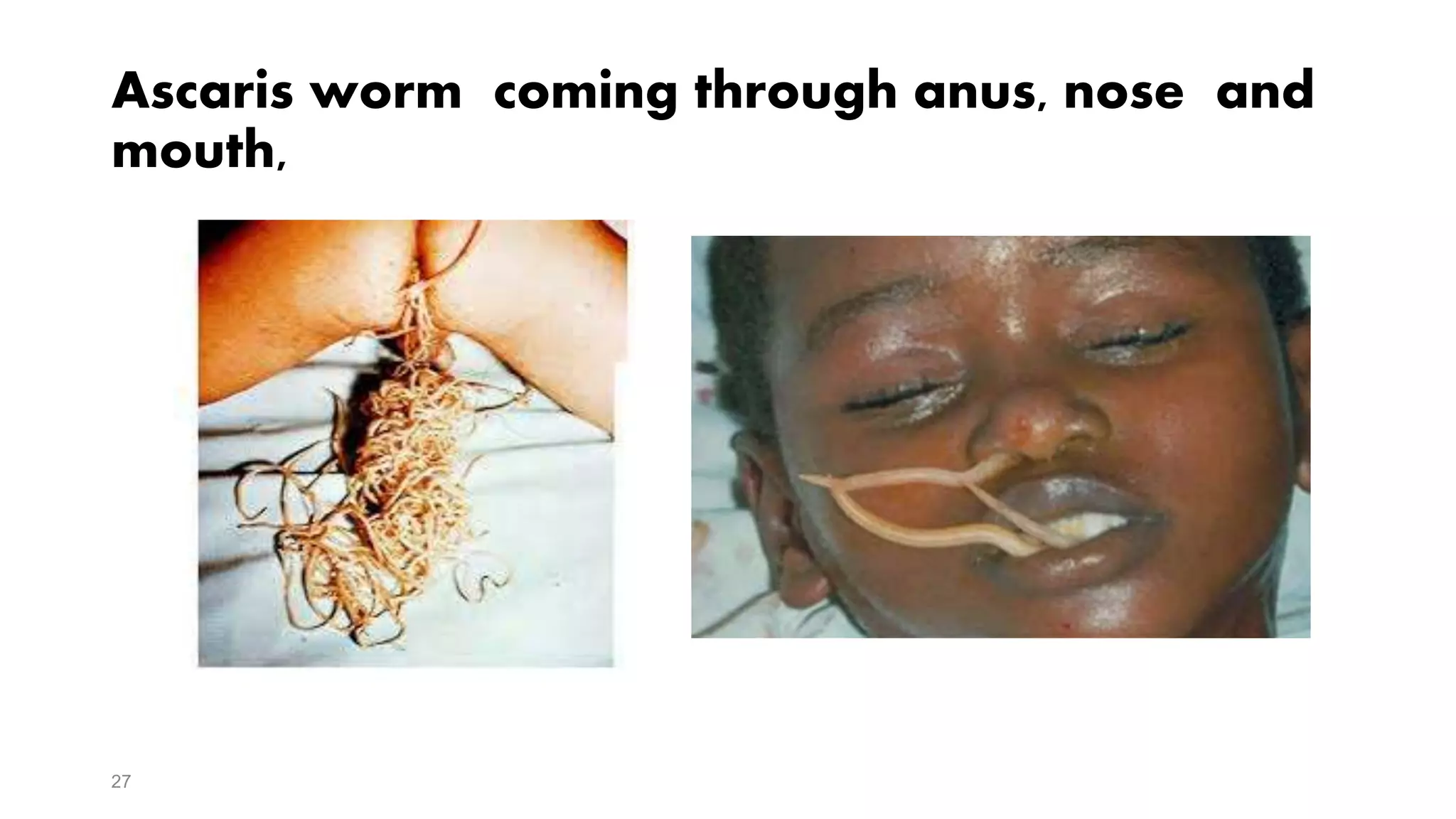 Ascaris Lumbricoides | PPTX