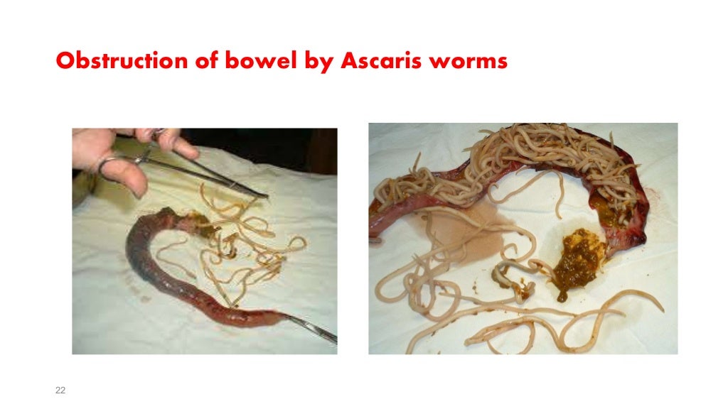 Ascaris Lumbricoides