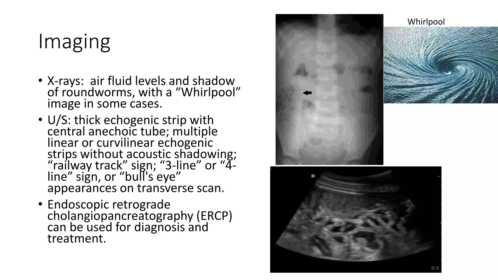 Ascaris and its surgical complications.pptx
