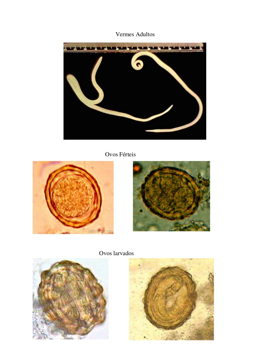Ascariasis Lumbricoides