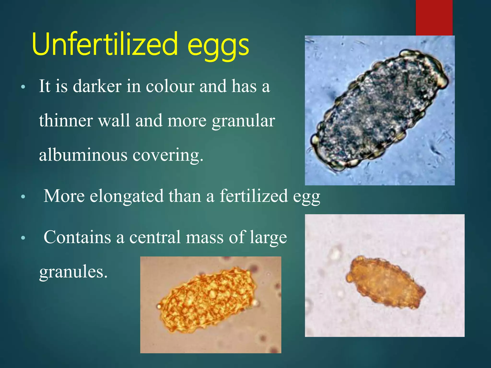Ascaris Lumbricoides Egg Ascariasis Microscopy Findings